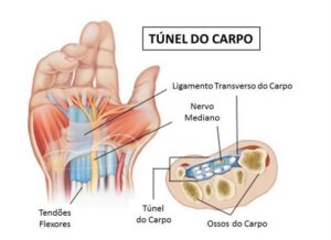 Síndrome do Túnel do Carpo: Causas, Sintomas e Tratamentos - Anatomia Fácil